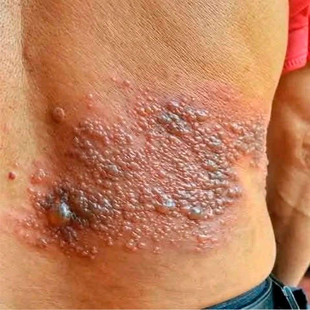 Picazón en el Cuerpo: Cuando una Presunta Alergia Puede Ser un ...